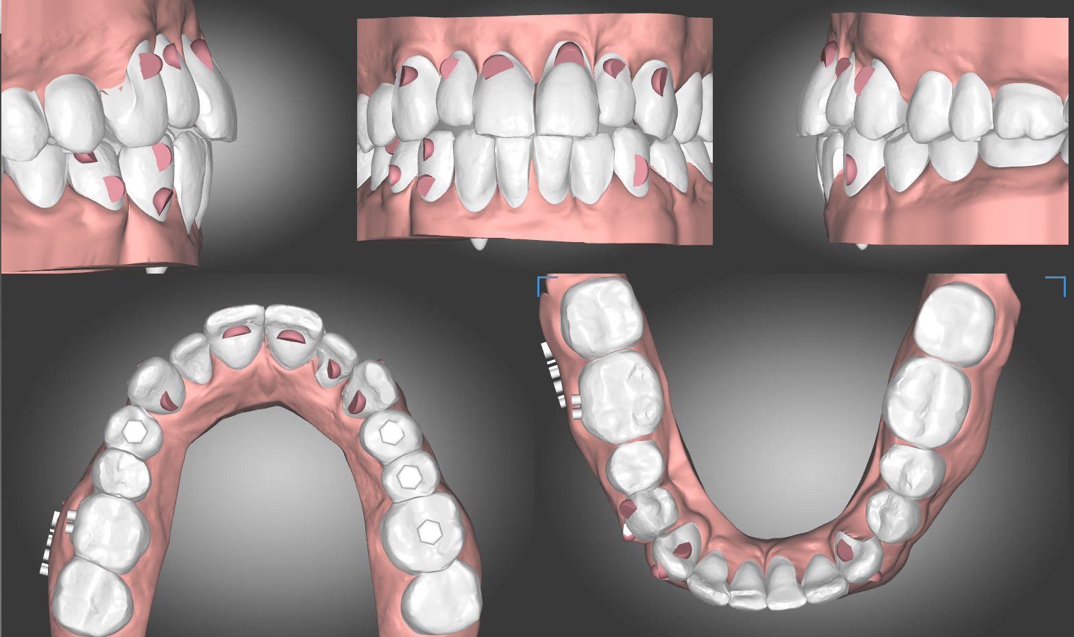 AO Attachment Protocol for Aligners – ADAPTIVE ORTHODONTICS