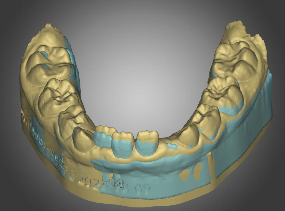Liam.E – Rapid Maxillary Expansion, Myofunctional Therapy – ADAPTIVE ...