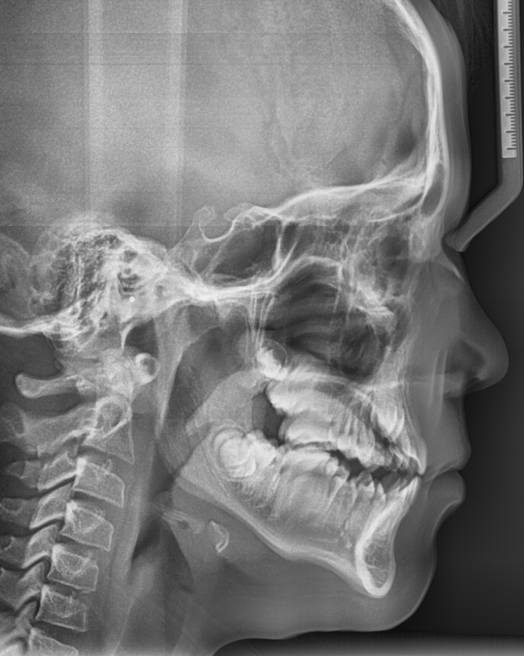 Alexander M. Class IIIB – ADAPTIVE ORTHODONTICS